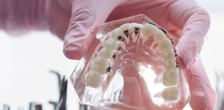 What are the Types of Braces Used in SA?